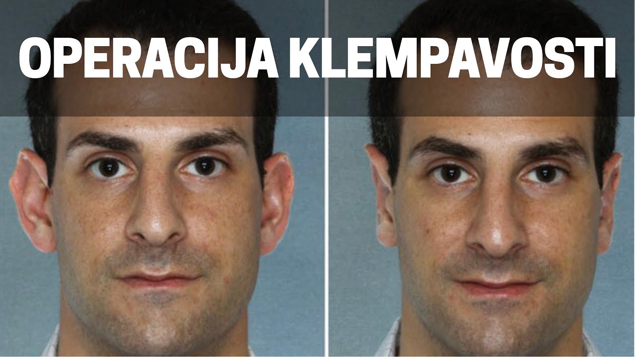 Klempave uši operacija, korekcija klempavih ušiju, klempavosti, cena ...