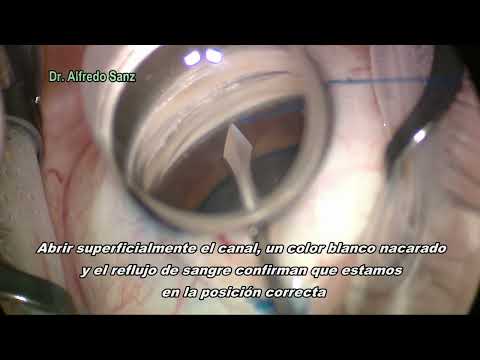 Trabeculotomía transluminal asistida por gonioscopia (GATT) paso a paso ...