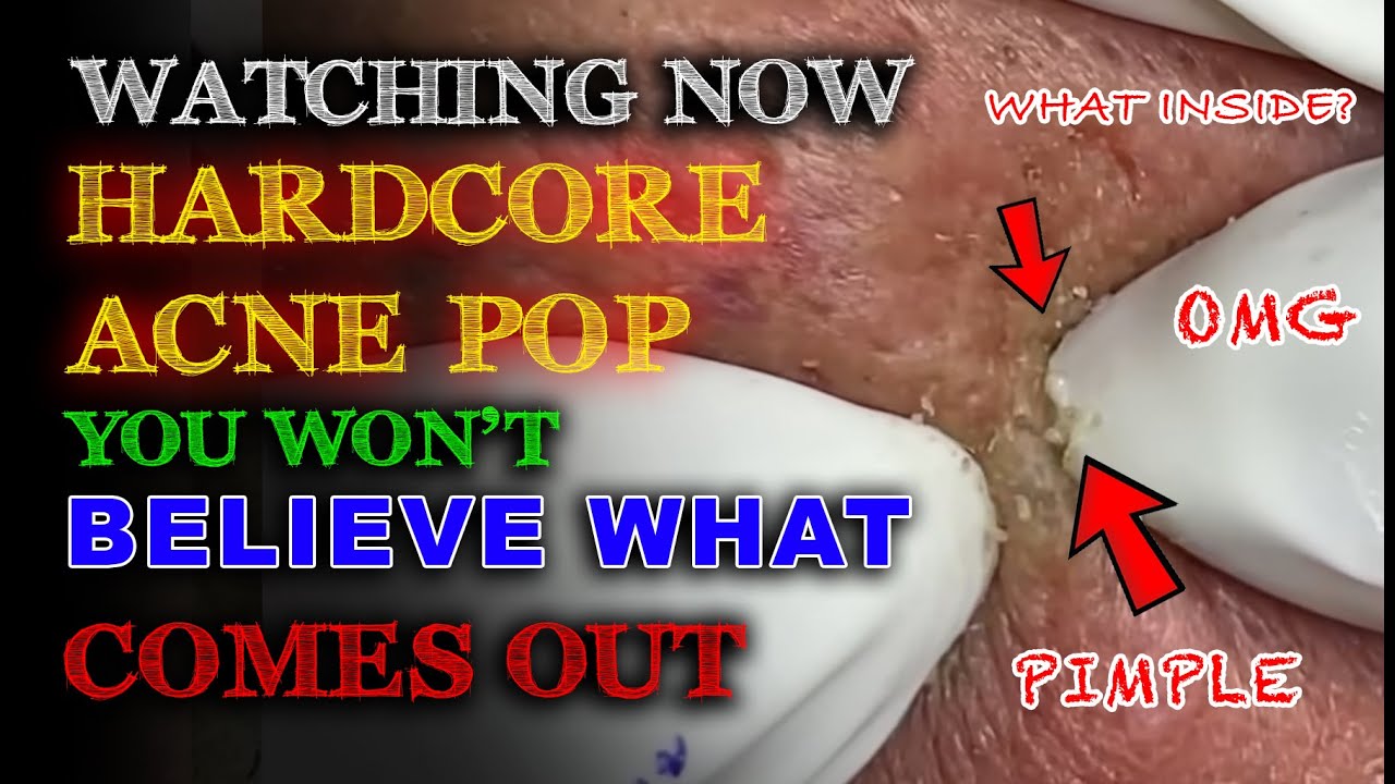 Hardcore Acne Pop – You Won’t Believe What Comes Out! - YouTube