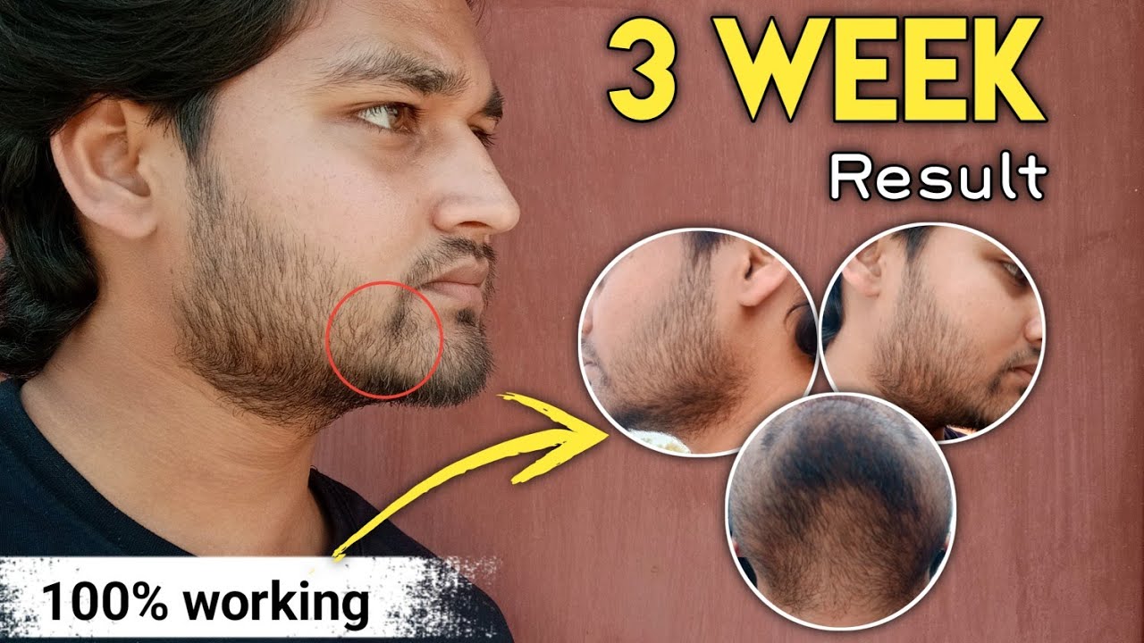 3 Week Beard Growth Result (पूरा दाढ़ी आ गया) | Beard Growth Tips ...