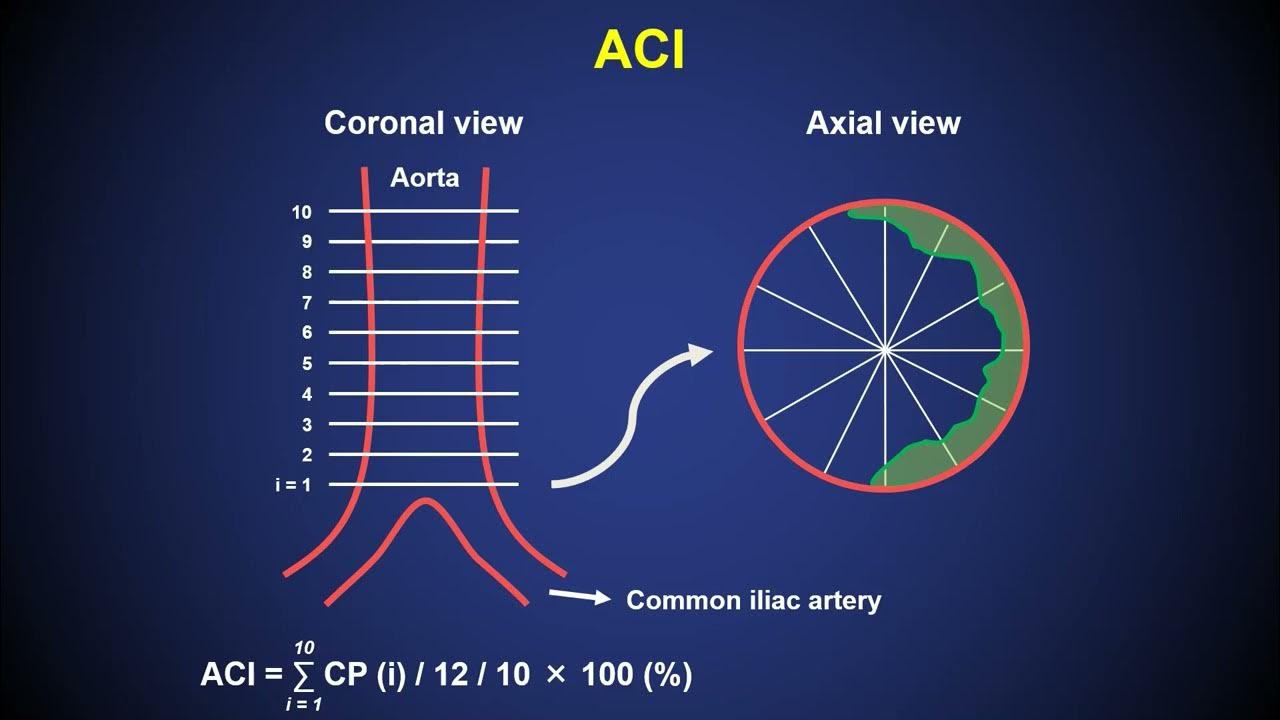 Aortic Calcification Burden And The Severity Of Erectile Dysfunction In