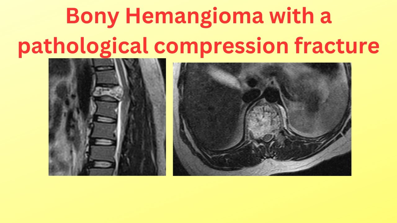 pathological compression fracture in lower dorsal spine - YouTube