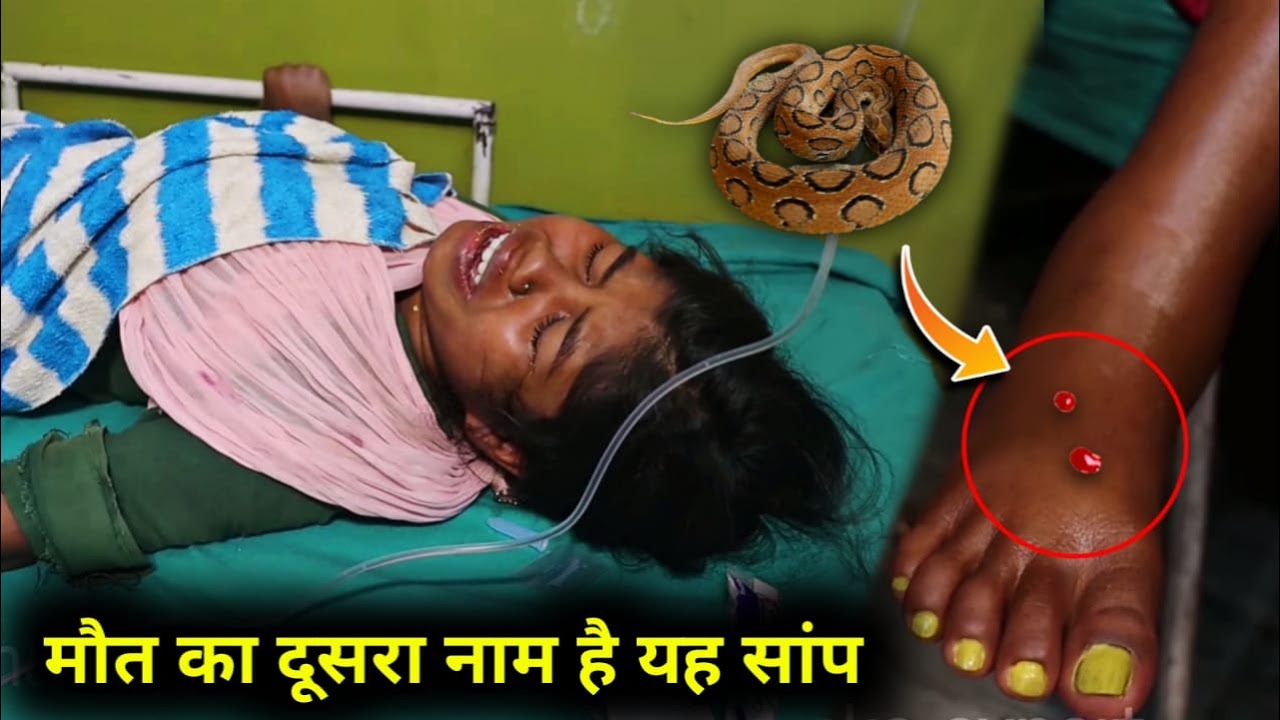 Russell's Viper Snake Bite बच्ची को जहरीले सांप ने डस लिया - YouTube