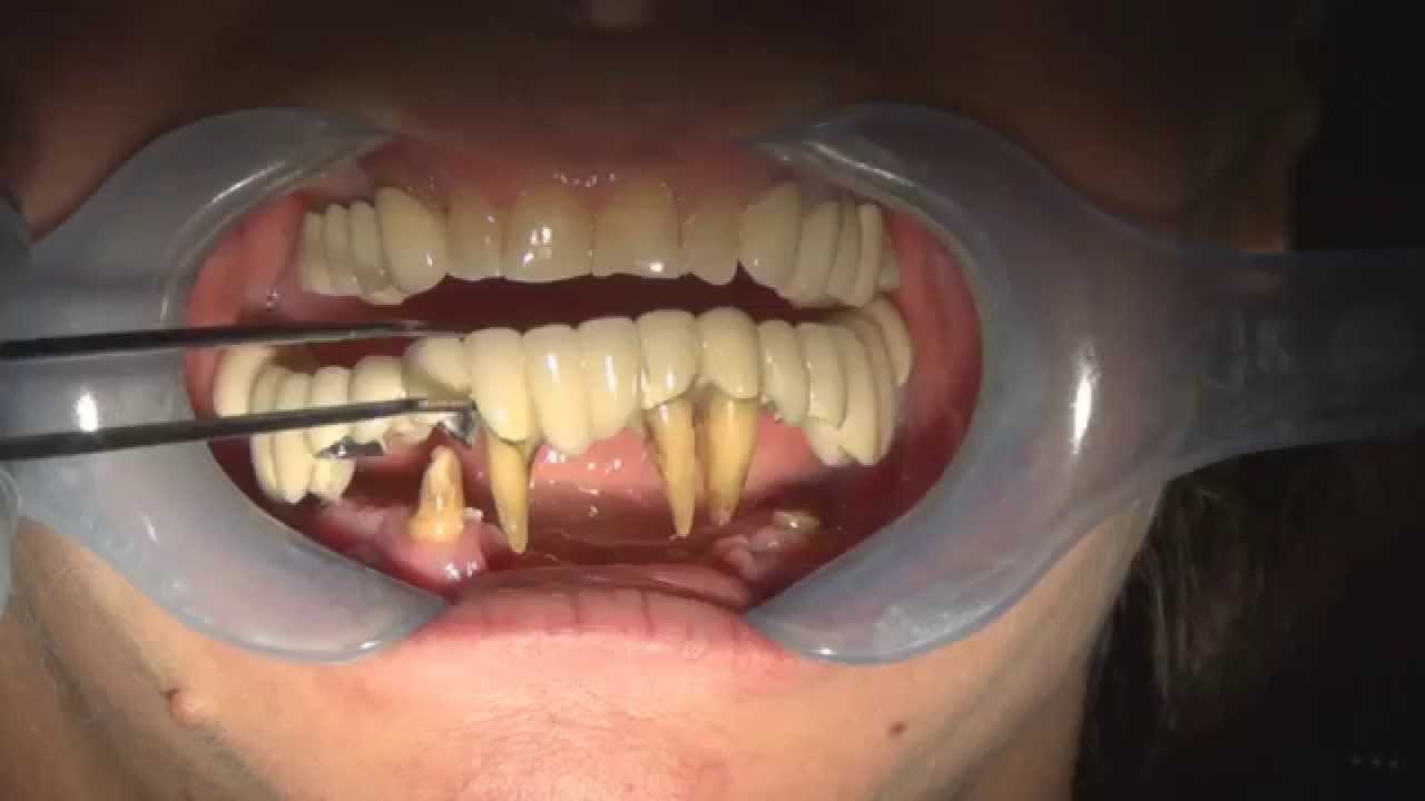 Pulling Teeth With No Numbing And Bleeding YouTube