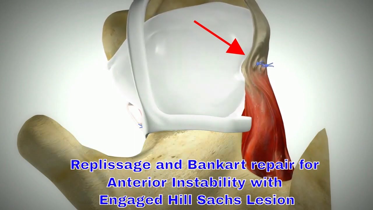 Shoulder Replissage and Bankart repair for Anterior Instability with ...