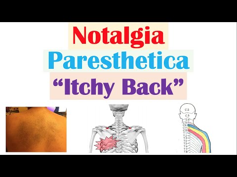Notalgia Paresthetica (“Itchy Back”) | Causes, Risk Factors, Symptoms, Diagnosis, Treatment