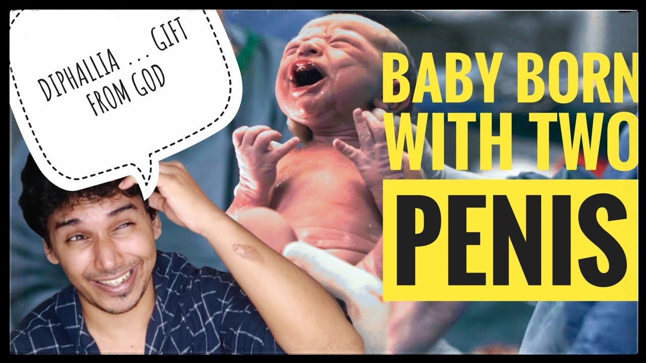 BOY BORN WITH 2 PENIS HAS LARGER ONE CHOPPED OFF|| DIPHALLIA|| MUST ...