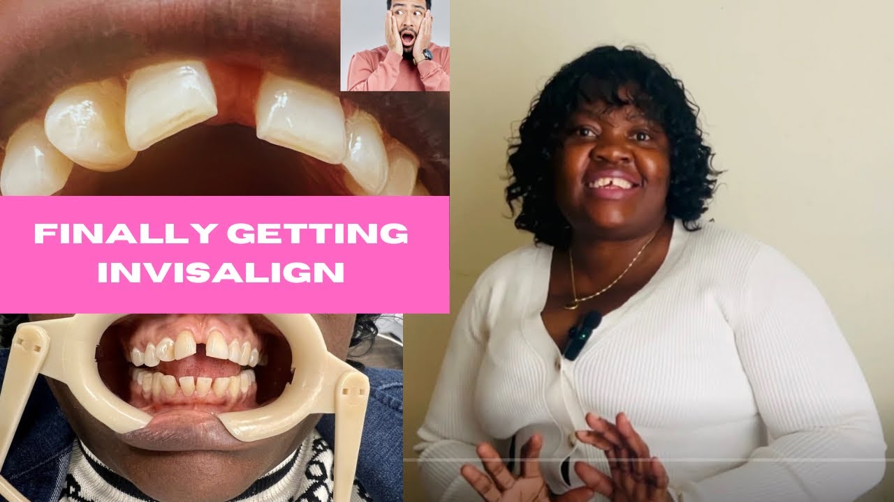 FINALLY GETTING INVISALIGN, GETTING MY SMILE FIX JOURNEY BEGINS. #invisalign #braces #newsmile ...