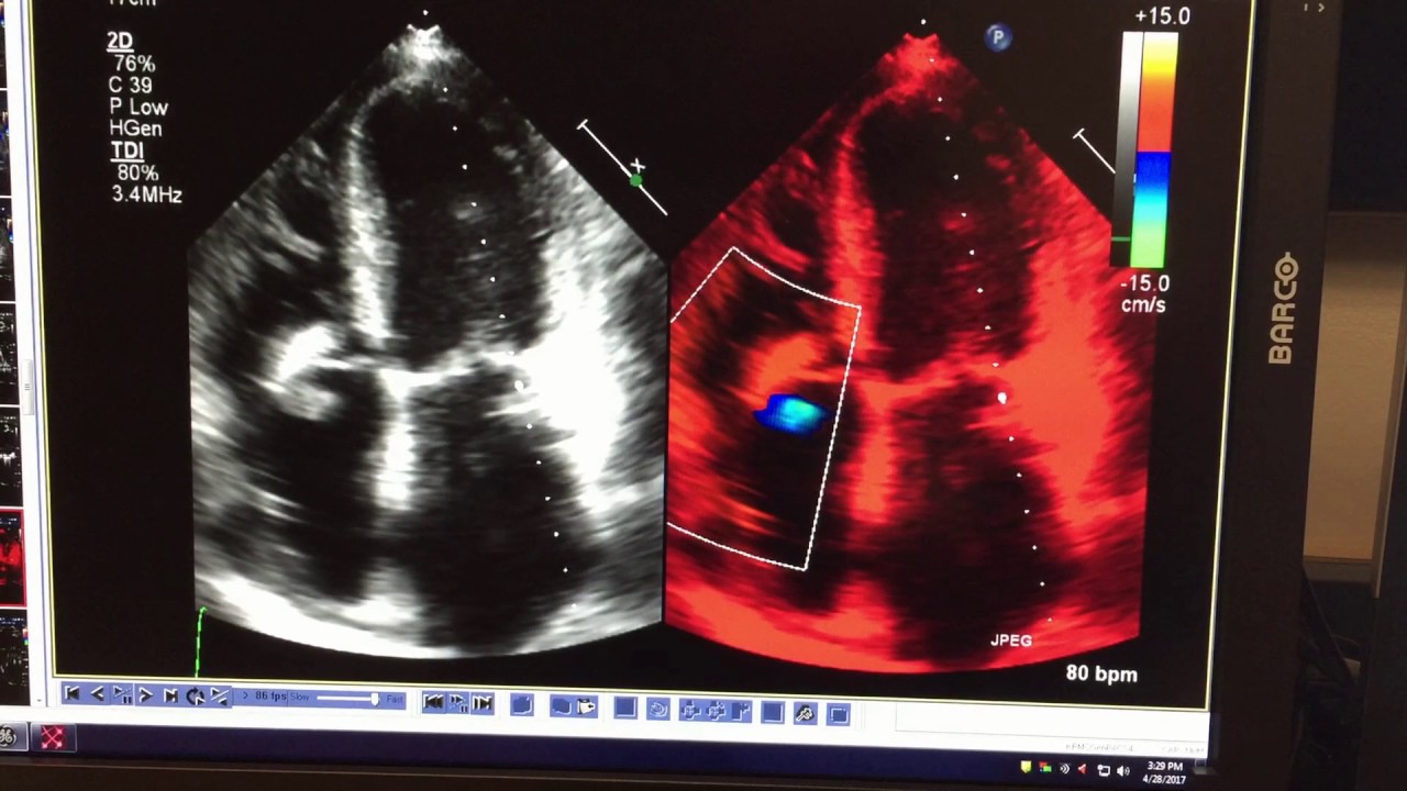 2d Echocardiogram Vegetation On ICD Pacer Wire YouTube 2d-echocardiogram-vegetation-on-icd-pacer-wire-youtube