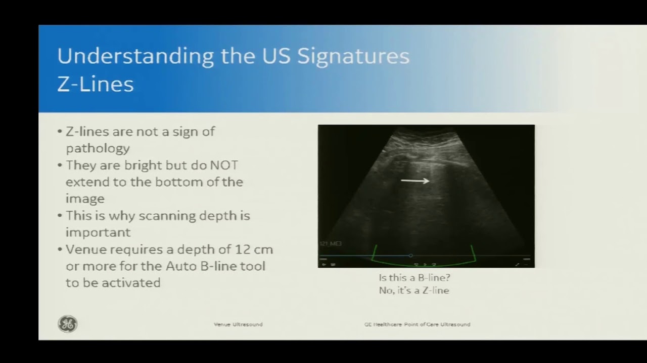 Understanding Lung Ultrasound Focus On B lines Cindy Owen RDMS RVT Understanding Lung Ultrasound Focus On B lines Cindy Owen RDMS RVT