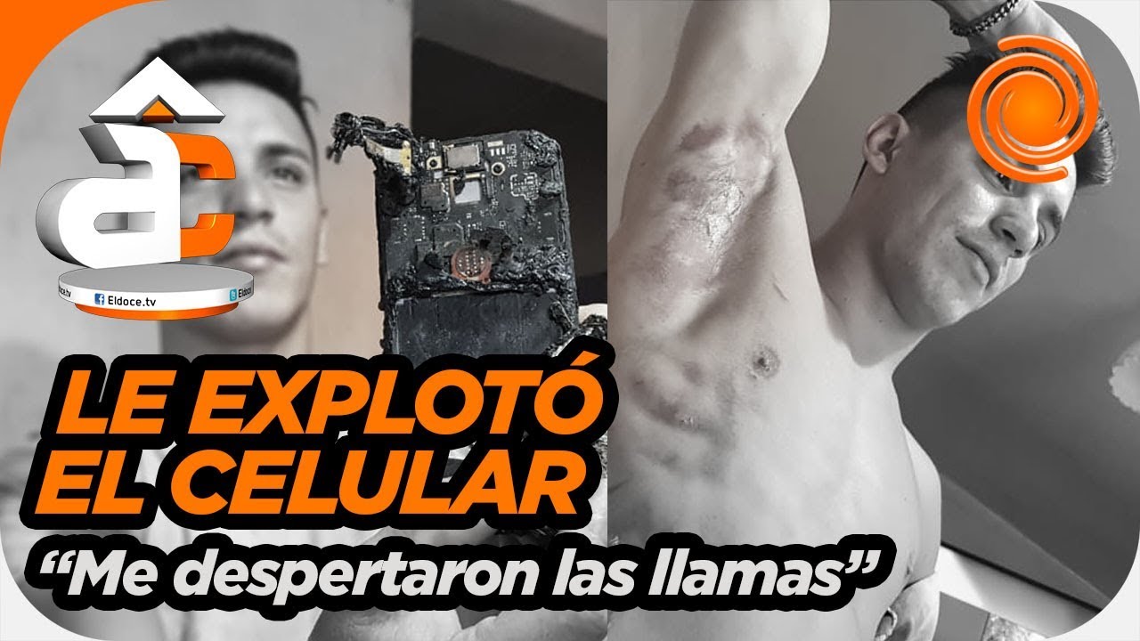 Le explotó el celular mientras dormía y sufrió graves quemaduras: pasó ...