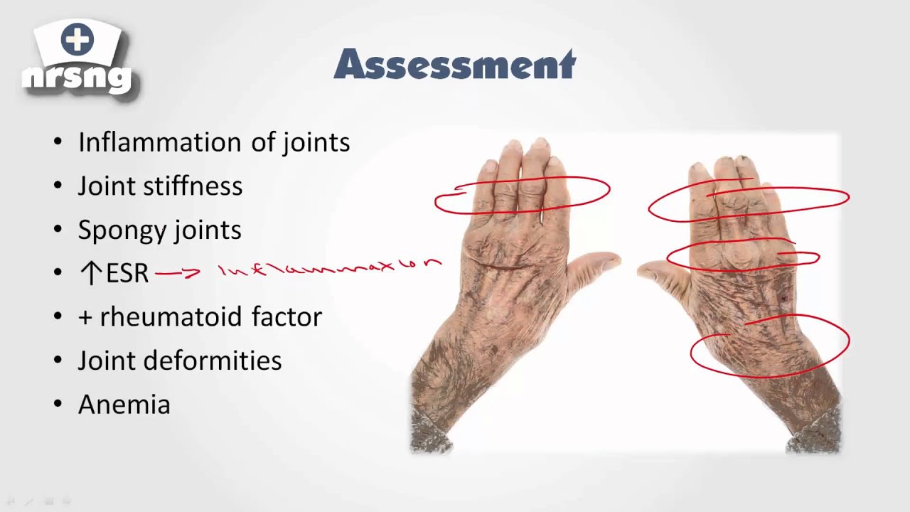 Arthritis NCLEX® Review | NRSNGacademy.com - YouTube