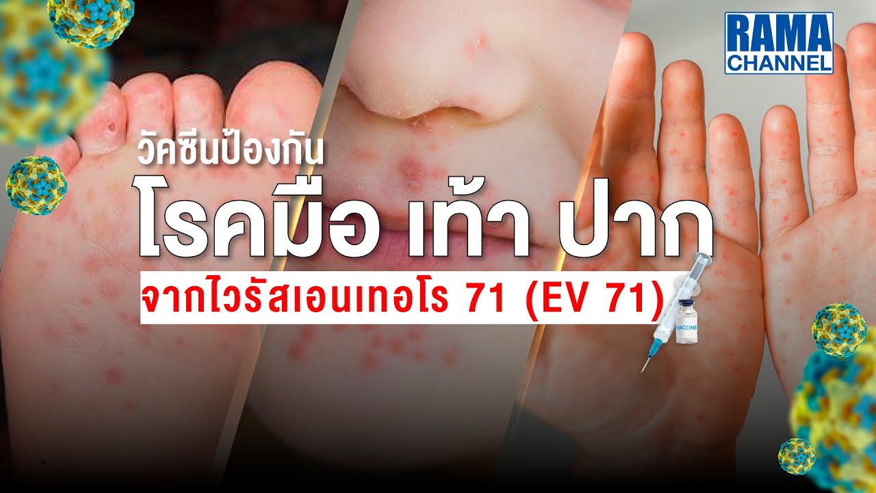 หมอรามาฯ เตือน #เชื้อEV71 รุนแรง แนะวิธีรักษา #โรคมือเท้าปาก - YouTube