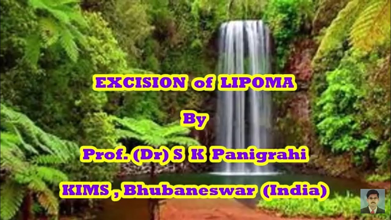 EXCISION of LIPOMA on the back - YouTube