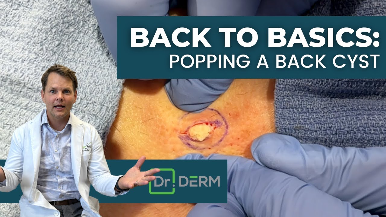 SATISFYING Back Cyst Removal From Start To Finish! | Dr. Derm - YouTube