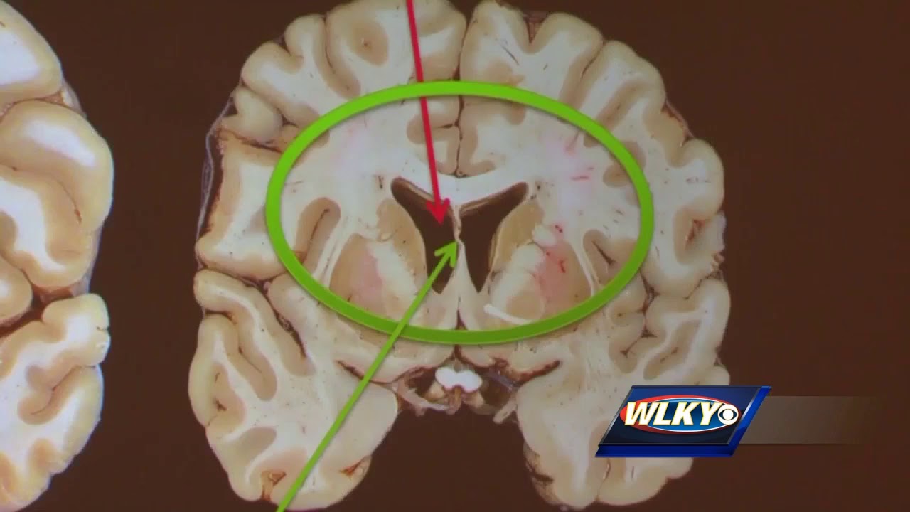 Local boxer likely suffering from CTE shares his story - YouTube