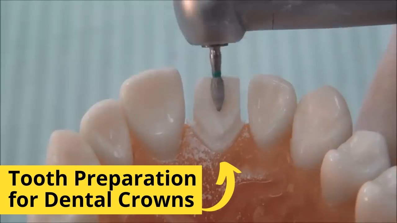 How to prepare a tooth! Dentistry for students - YouTube