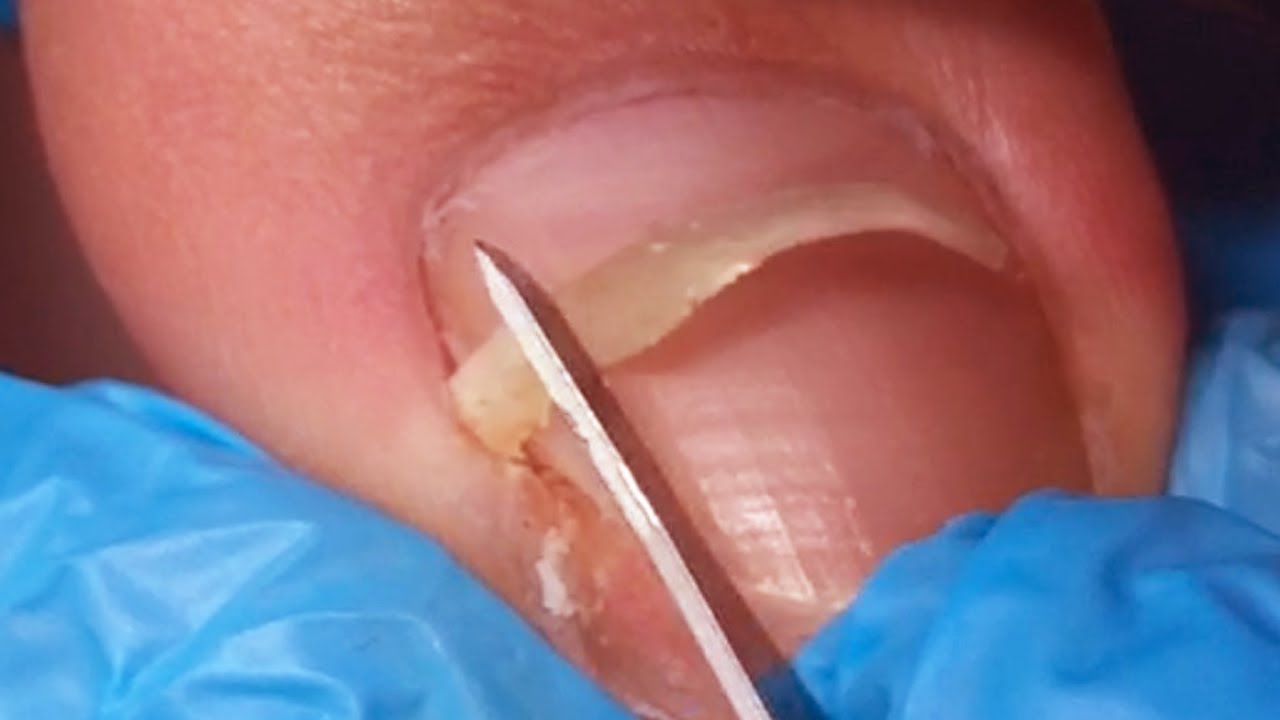 Pull out the deep ingrown nails and clean the dead skin between the ...