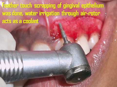 Gingival Depigmentation Procedure Using Diamond Bur... Case By Dr ...