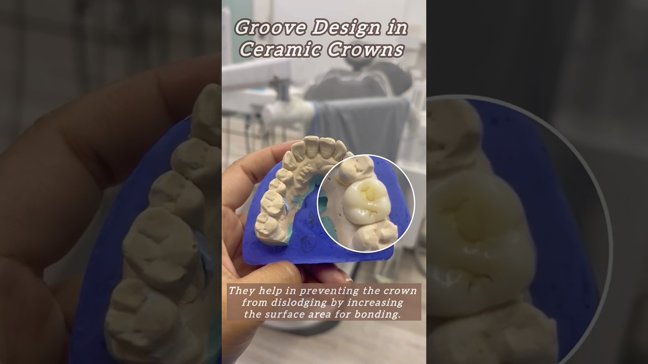 Groove design in Ceramic Crowns ensures better retention, stability ...