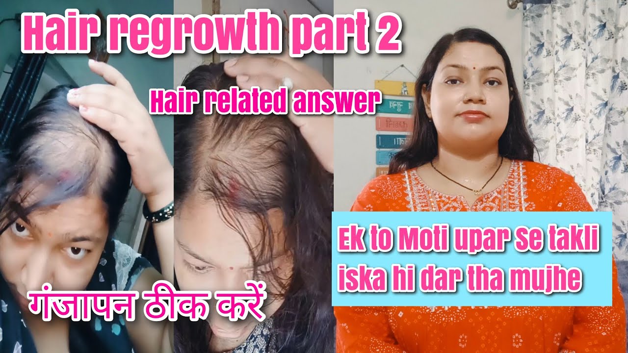 Ek to Moti upar Se takli | hair regrowth journey | kaise baldness theek ...