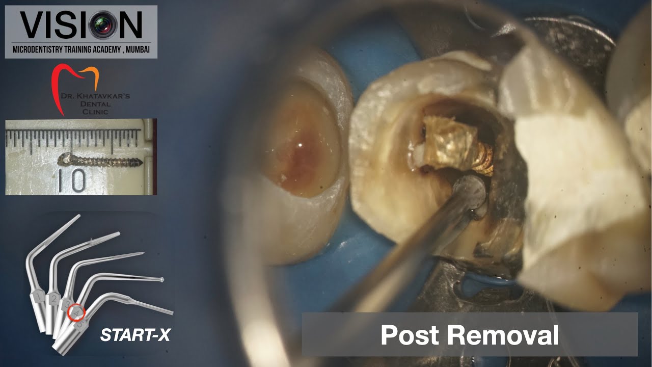 Metal Post Removal - YouTube