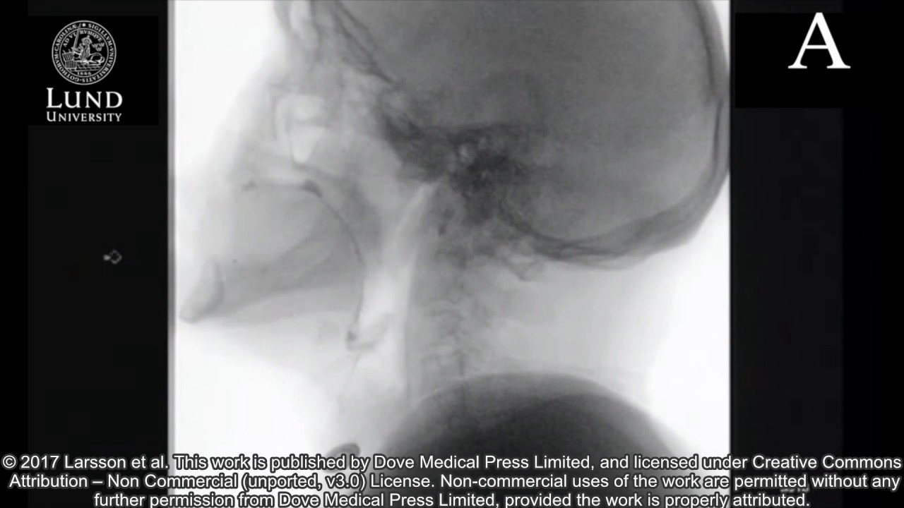 Carbonated liquid and swallowing in Lewy body dementias - Supplementary ...
