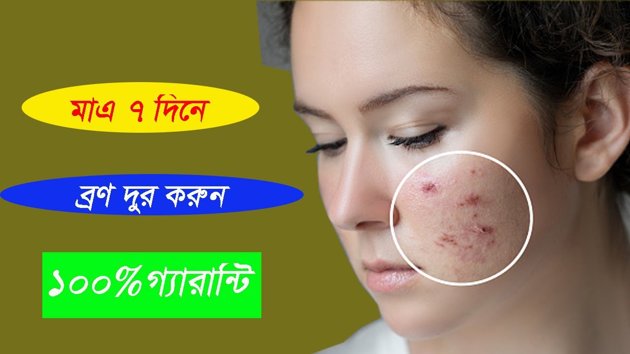 A Mycin Lotion, Erythromycin,acne, pimples, ব্রণ দুর করুন মাএ ৭ দিনে ...