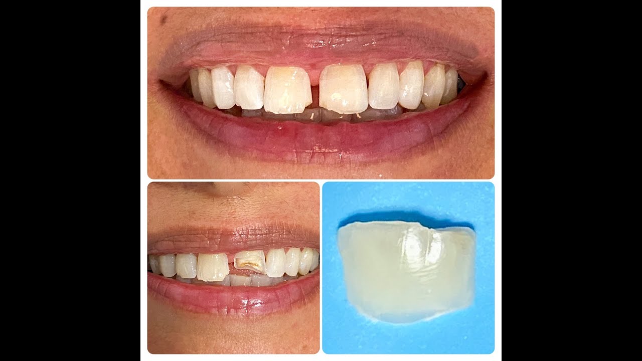 Split-Tooth Reattachment | Culver City, CA Dentist | Nima Shayesteh ...