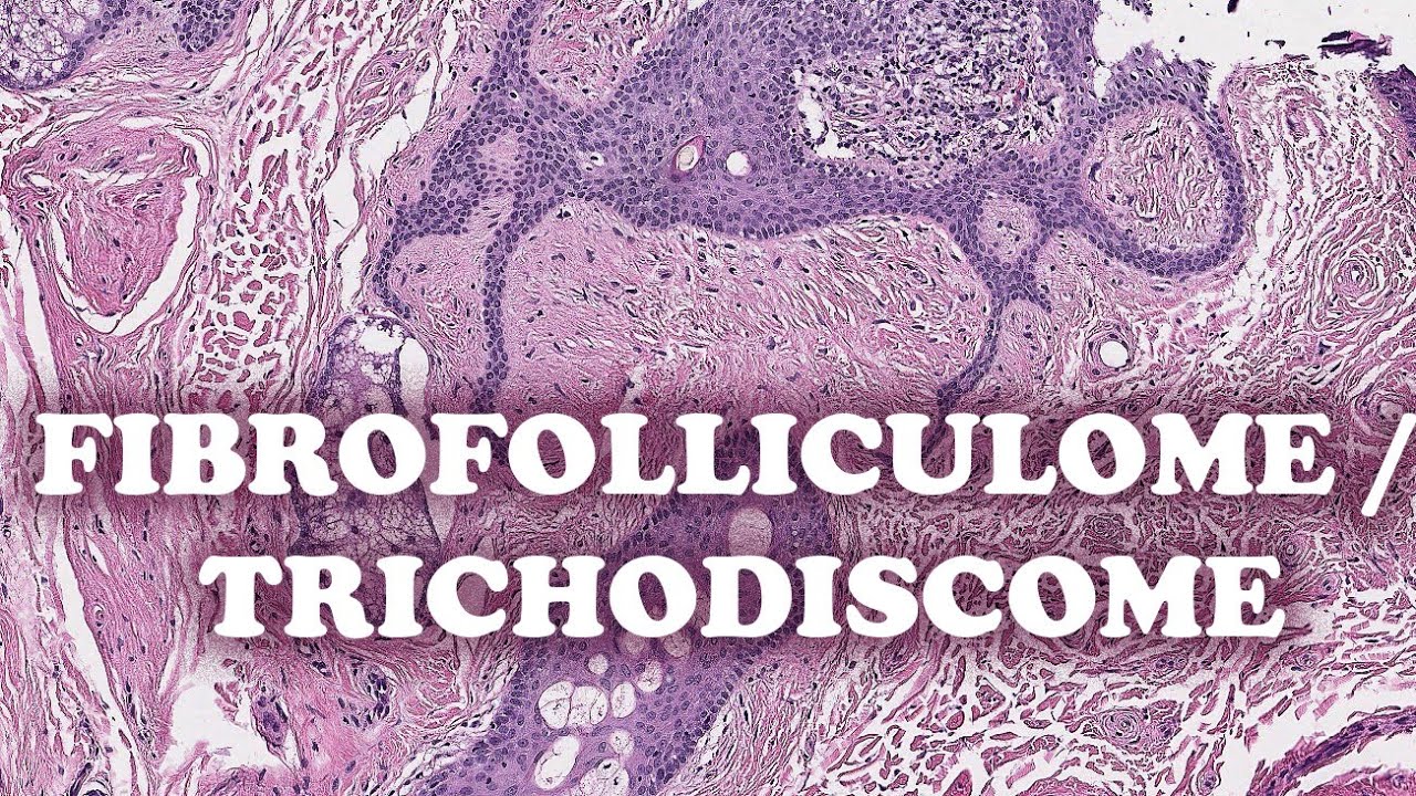 LE FIBROFOLLICULOME / TRICHODISCOME - PATHOLOGIE - YouTube