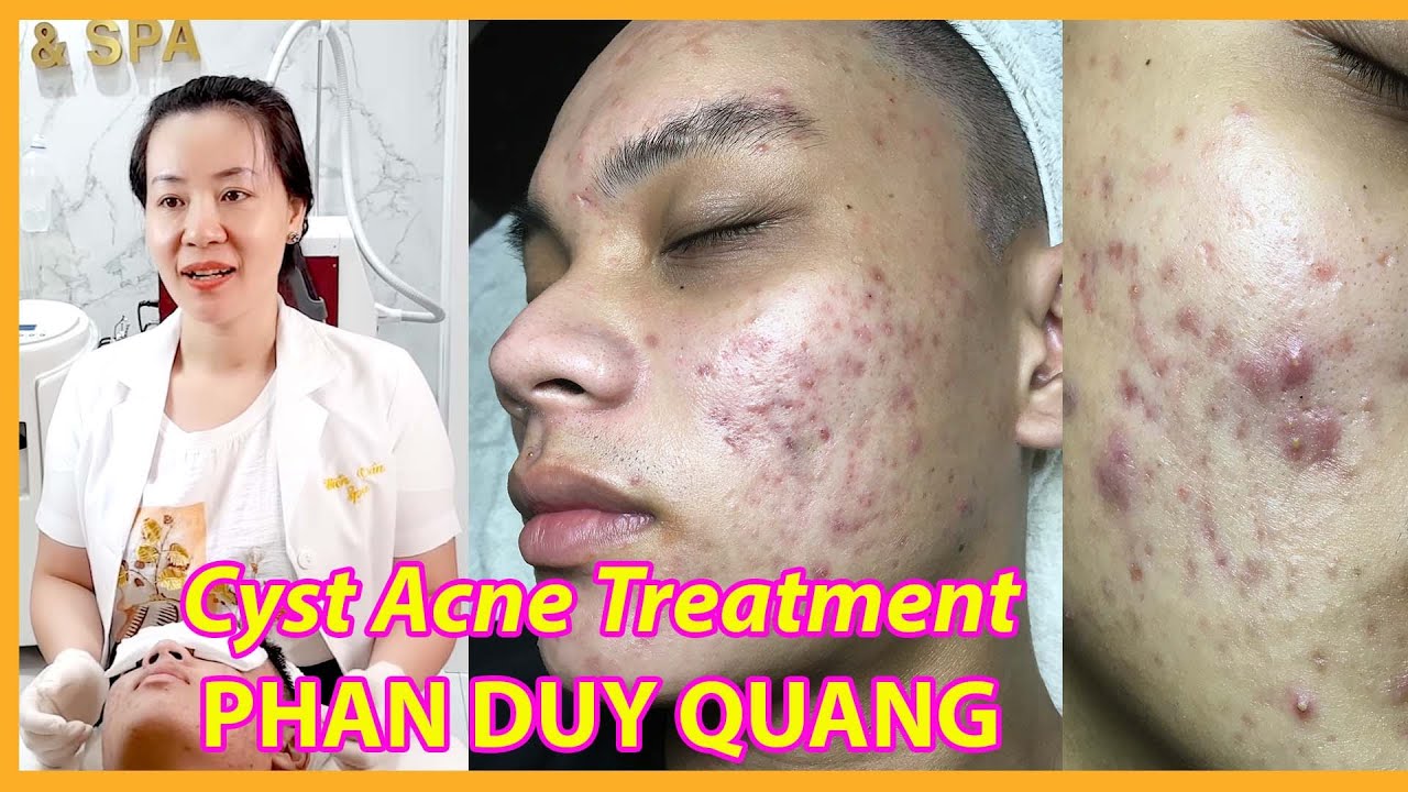 Cyst Acne Treatment | Điều trị mụn hiệu quả số 1 TPHCM | Hiền Vân Spa ...