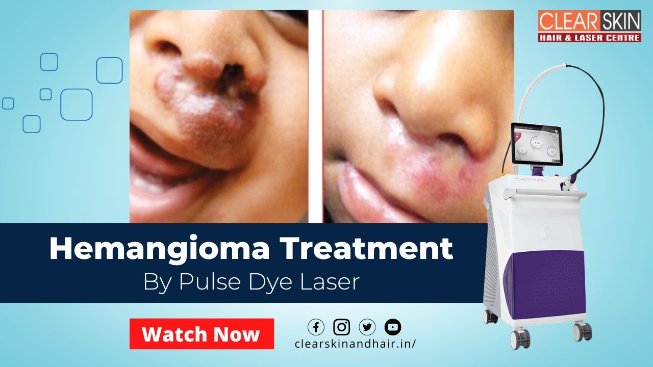Hemangioma Treatment by PDL Pulse Dye Laser || Pulsed Dye Laser Treats ...