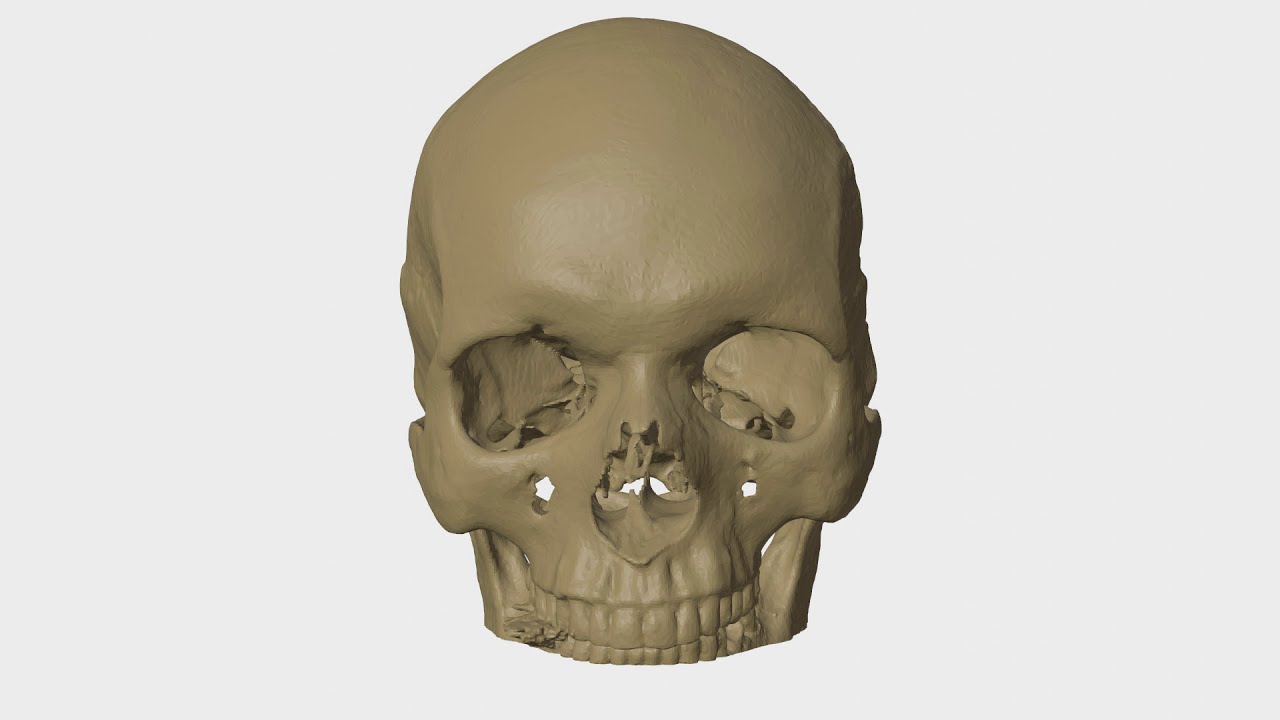 Cranioplasty – Customised Cranial Prosthesis - YouTube