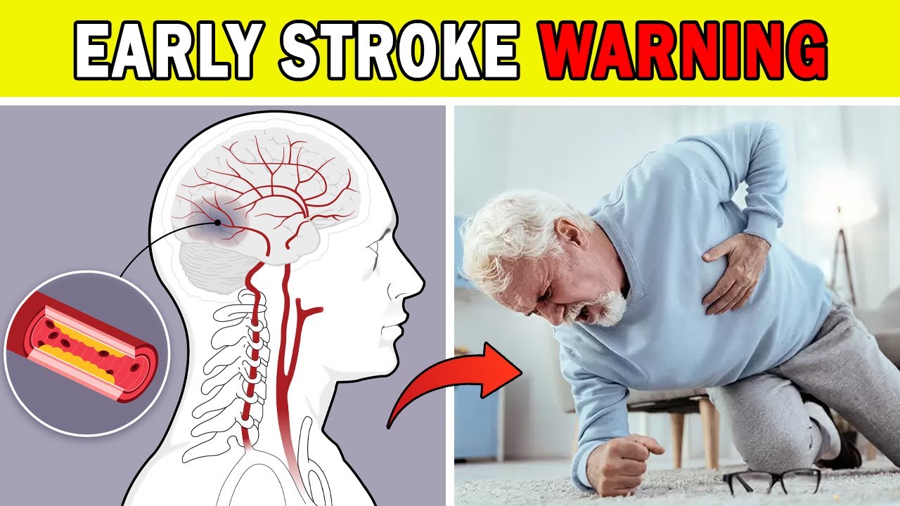 Stroke Alert: Could You Be Ignoring These Early Warning Signs? - YouTube