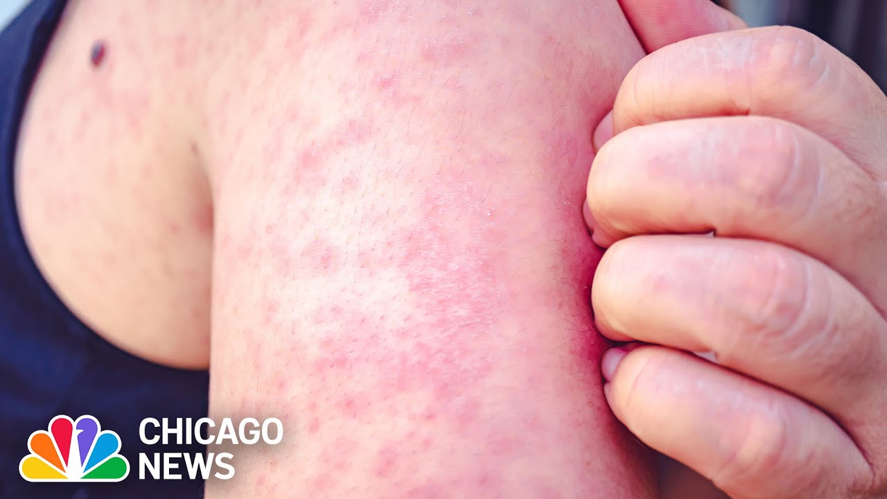 How is MEASLES treated? Chicago health officials confirm 2 cases in the ...