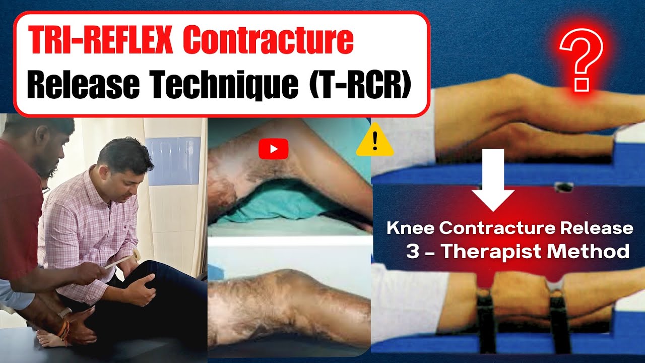 Tri-Reflex Knee Contracture Release Technique (T-RCR). - YouTube