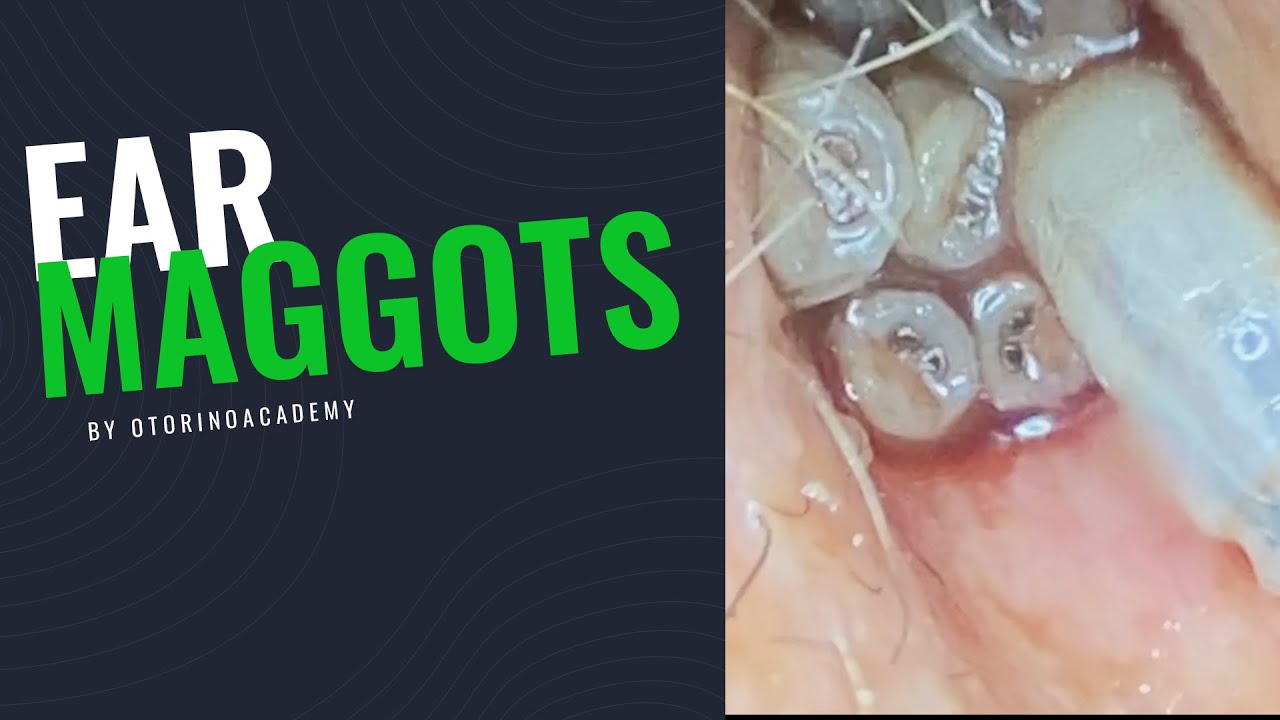EAR MAGGOTS (COMPLETE VIDEO - FULL TREATMENT) - YouTube