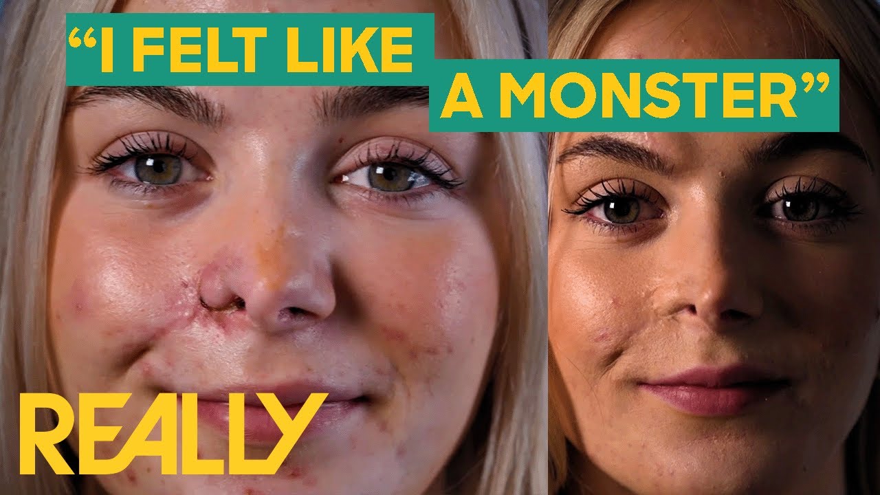 Doctors Reconstruct Nose Of Dog Attack Victim | The Face Doctors - YouTube