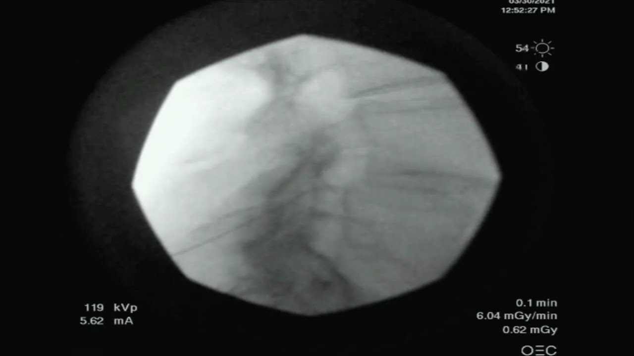 Fluoroscopic Lumbar Epidural Injection Lateral Contrast Spread Youtube
