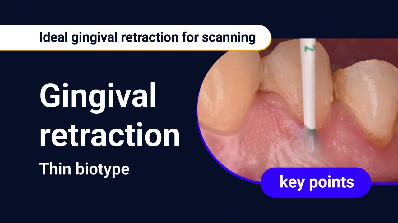 Thin biotype : Ideal gingival retraction for scanning - YouTube