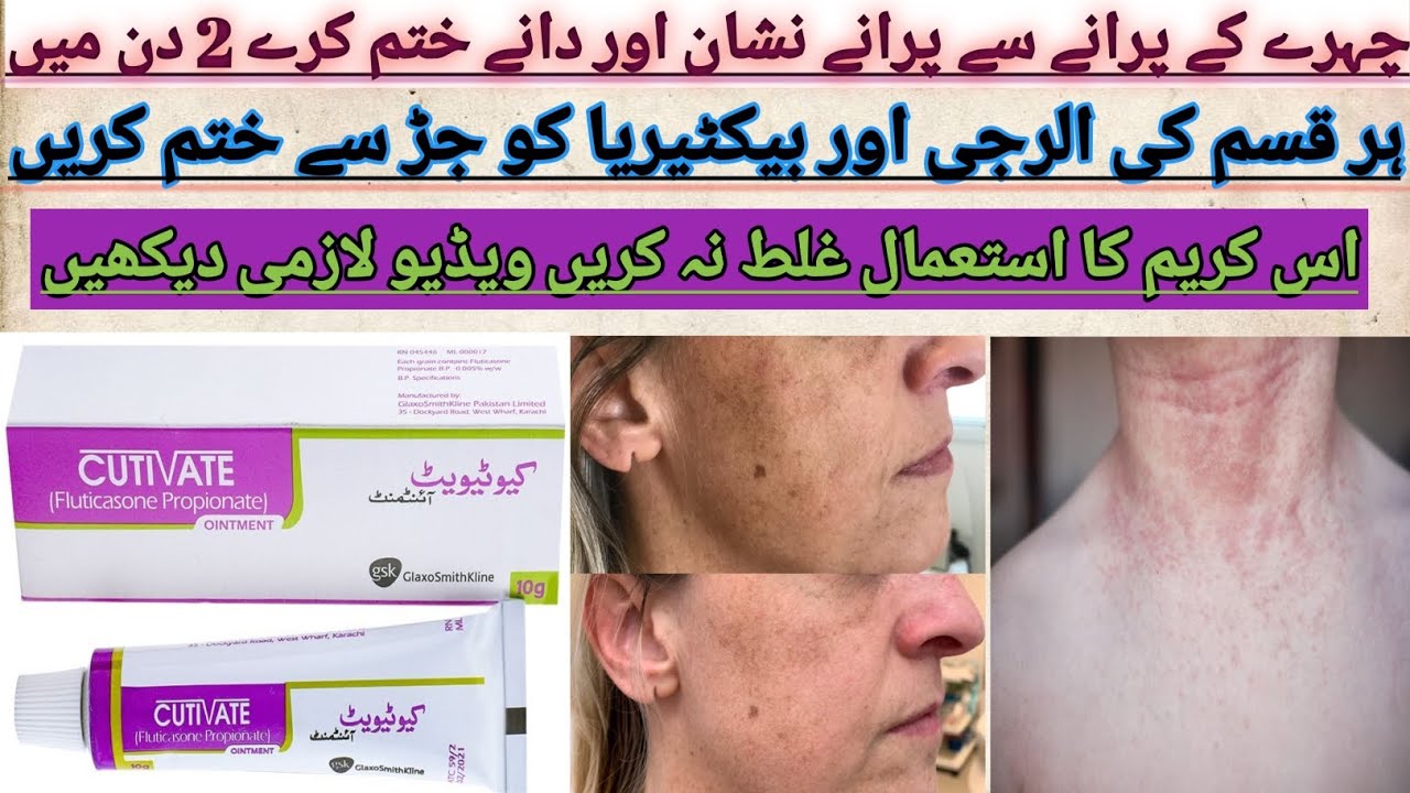 CUTIVATE Ointment Review| Fluticasone Propionnate| Anti Allergy ...