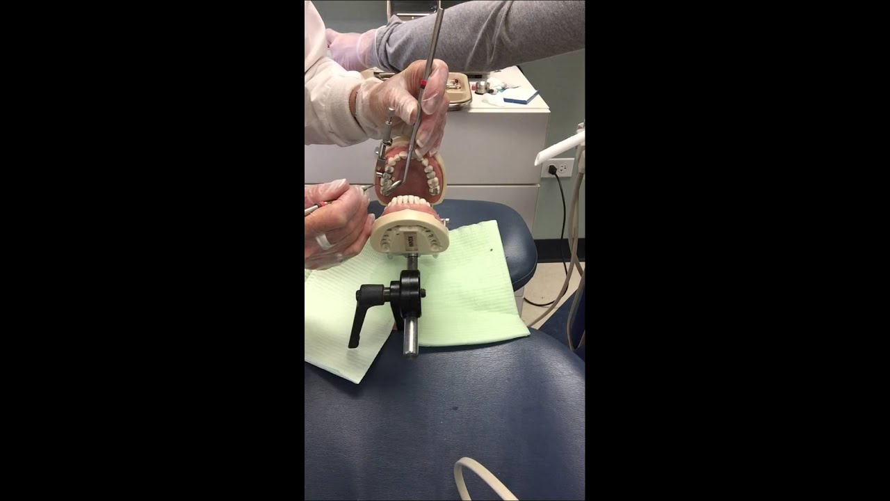 Amalgam procedure for DA part 2 - YouTube