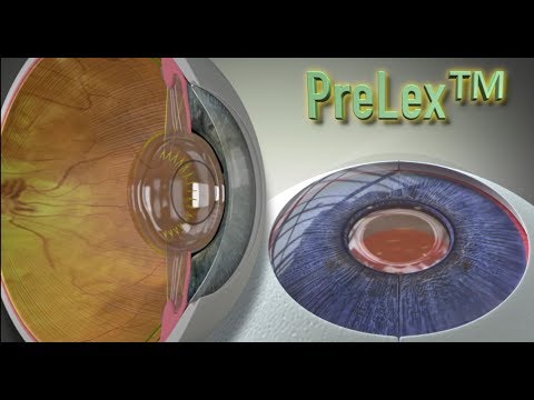 What is PreLex™? - YouTube