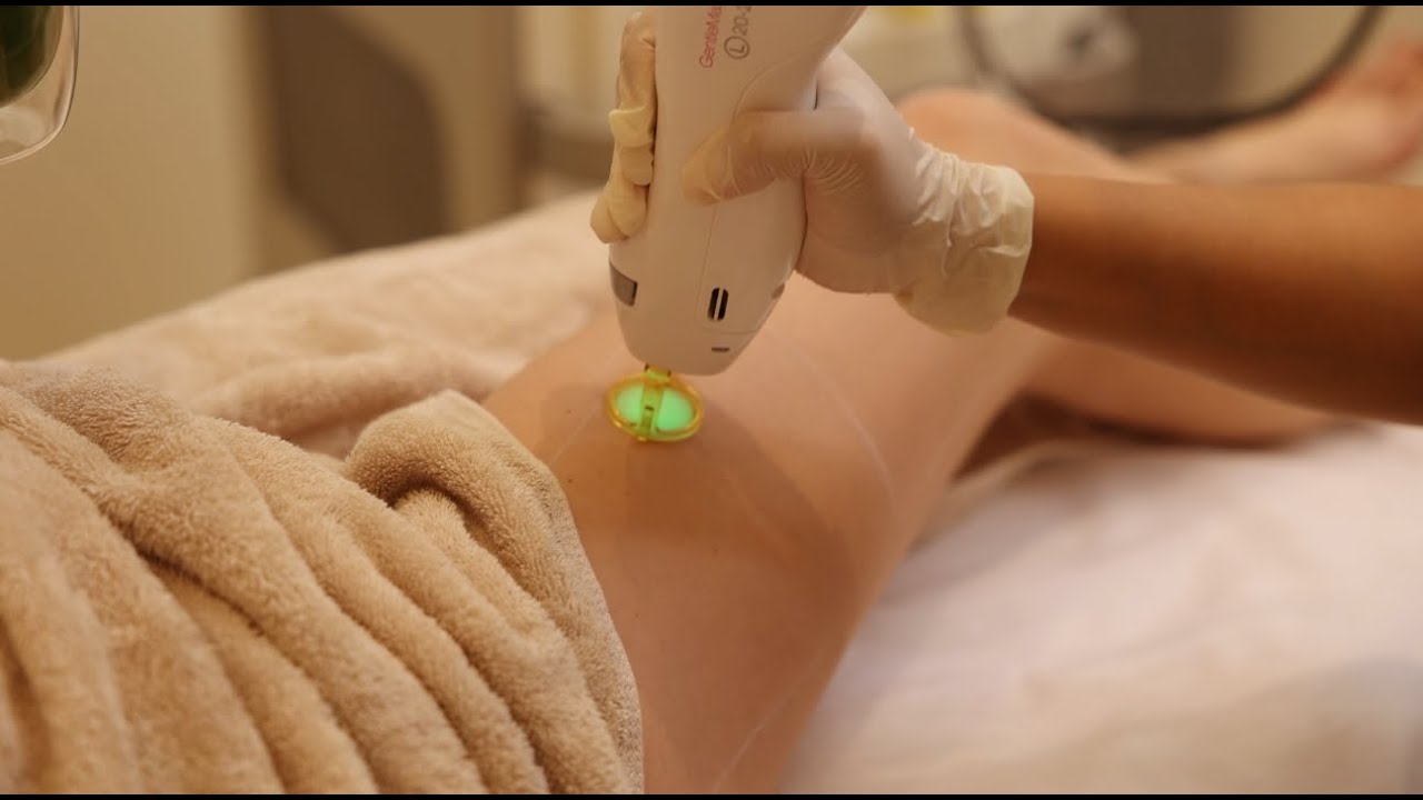 Revolutionary Skin Treatments with Candela Max Pro at Seline Clinic ...