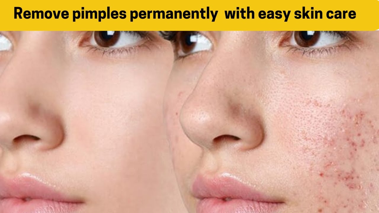 #How to remove pimples naturally and permanently/how to remove pimple ...