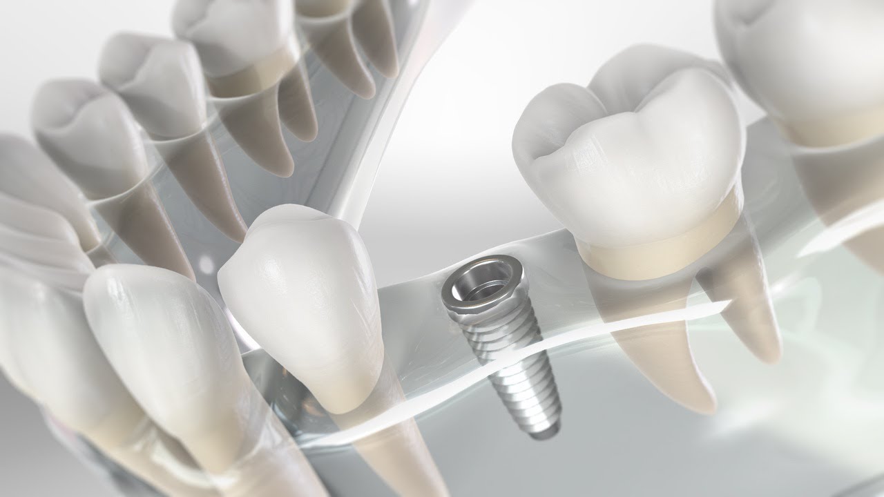Dental Implants (3D Animation) - YouTube
