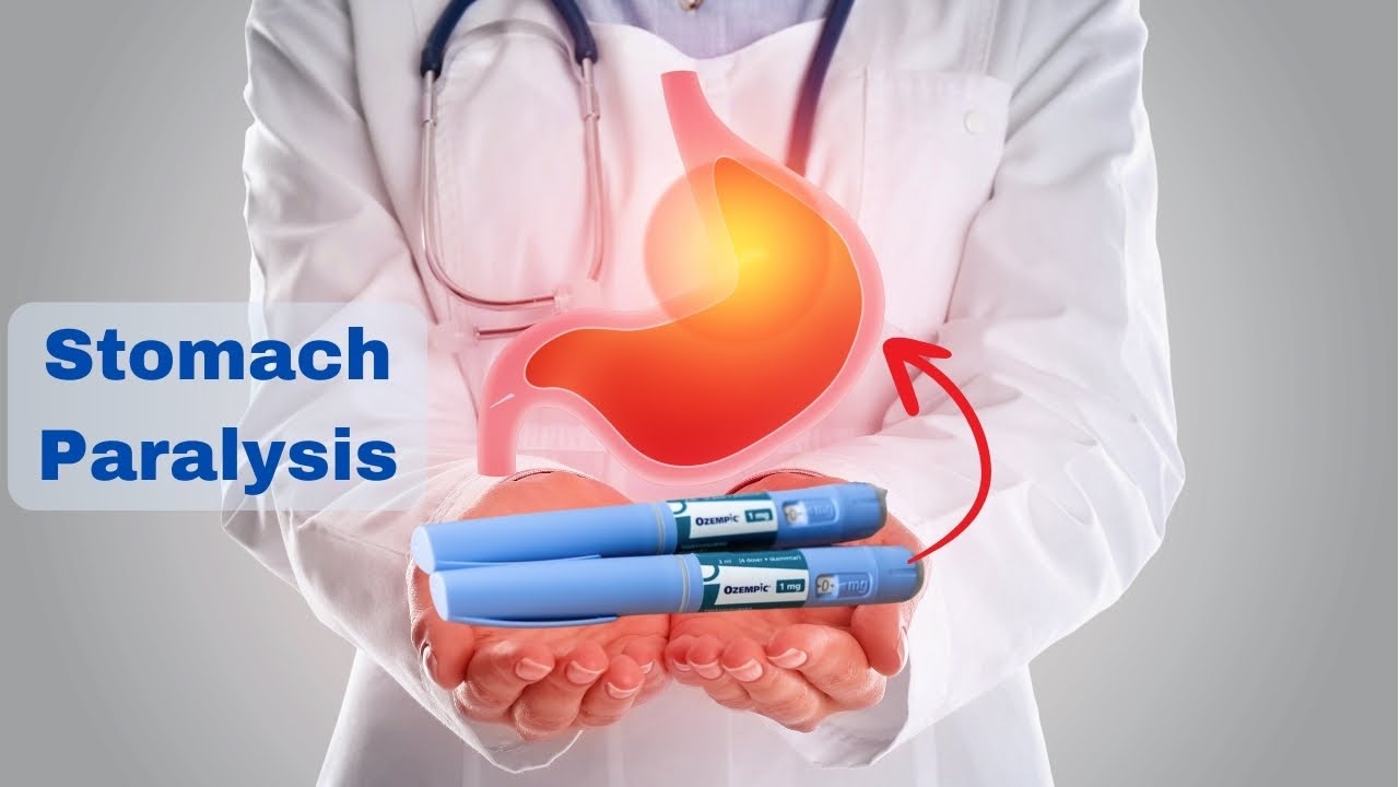 The Reality of Ozempic Stomach Paralysis: What You Need to Know ...