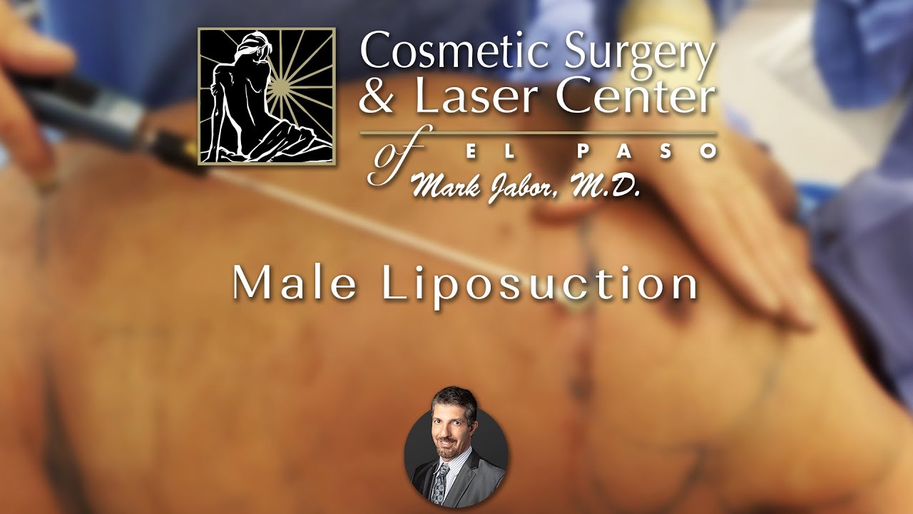 Male Liposuction Abdomen, Chest & Flanks - Dr. Mark Jabor - YouTube