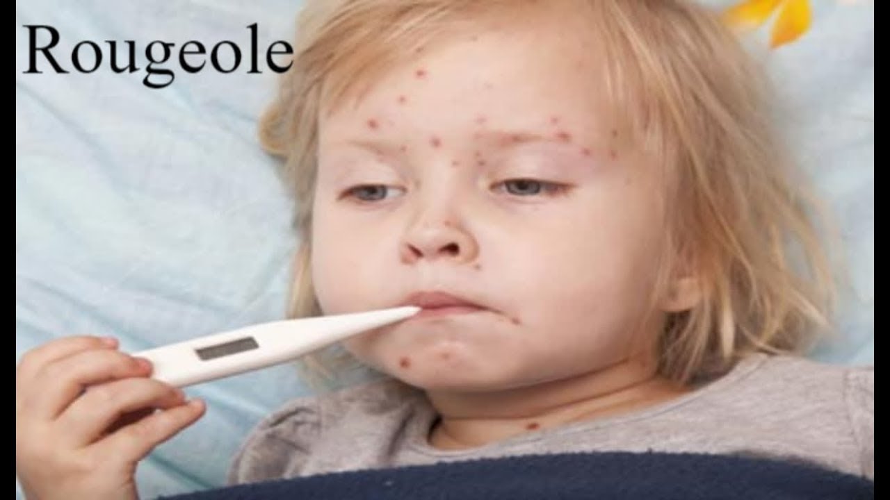 Rougeole : 3 Symptômes À Connaître - YouTube