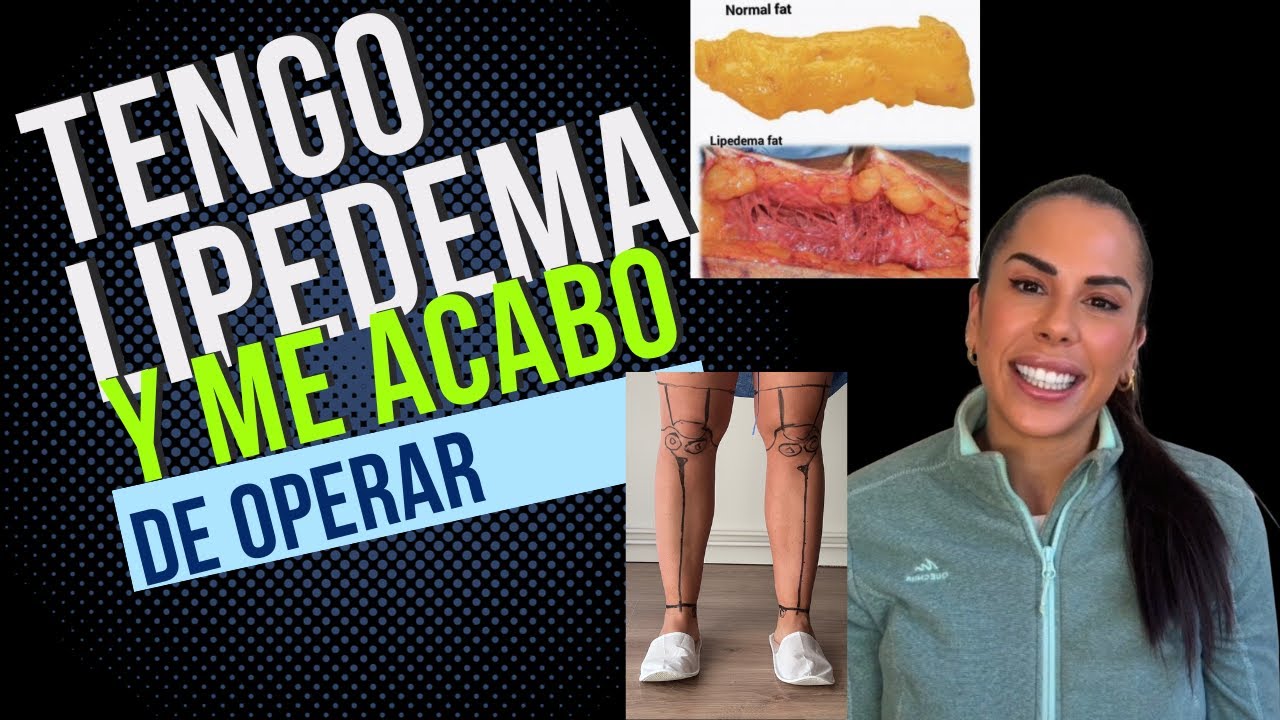 LIPEDEMA. Mi experiencia (Esteffi.goals) - YouTube